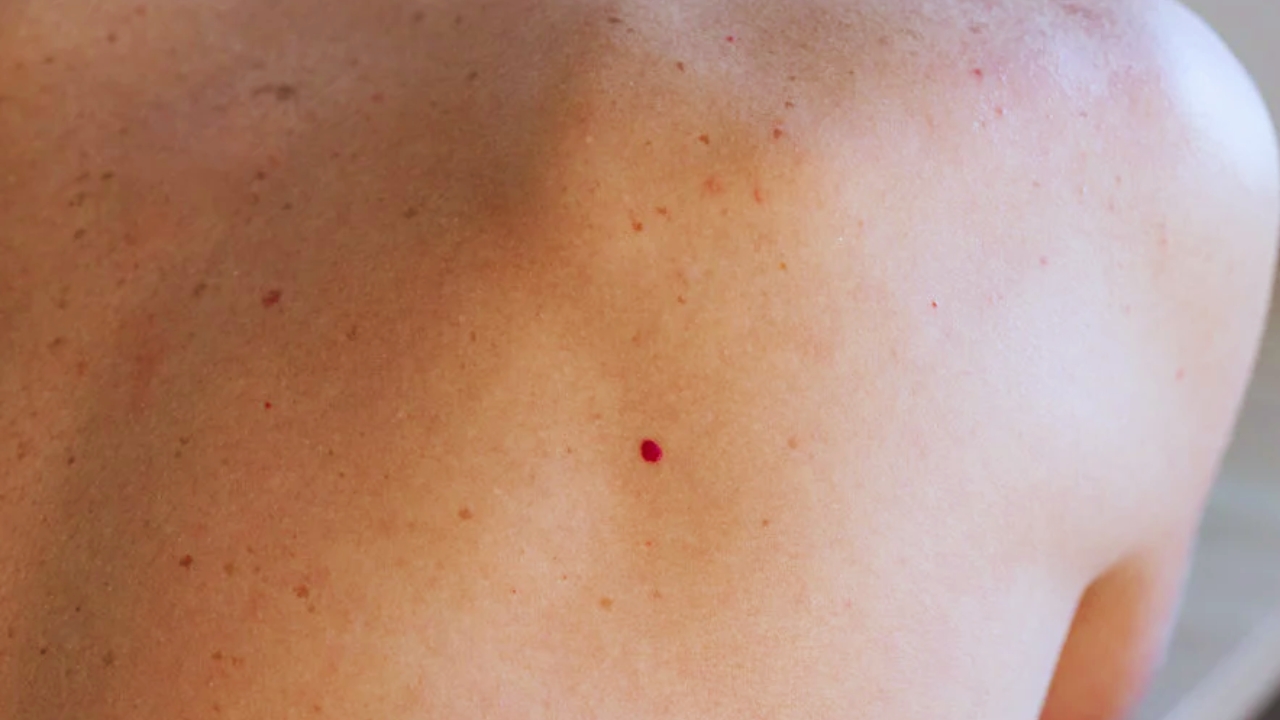 Fleke na koži - Zašto se pojavljuju i kako ih se rešiti - Viva By Ela ...