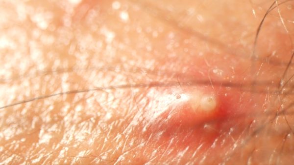 Potkožne bubuljice - Uzroci i efikasne metode lečenja - Viva By Ela ...